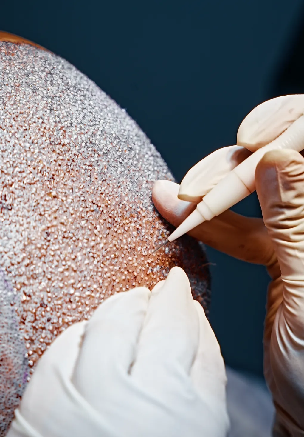 Sule Hair Clinic — Hair Transplant Istanbul