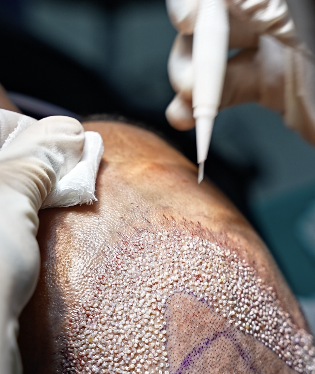 DHI Hair Transplant - Choi Pen Technique | Sule Hair Clinic Istanbul
