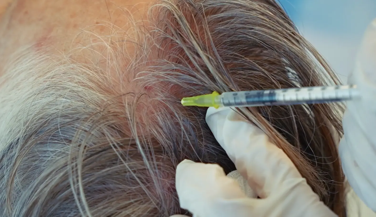 Exosome Therapy - Supportive Hair Care | Sule Hair Transplant Istanbul