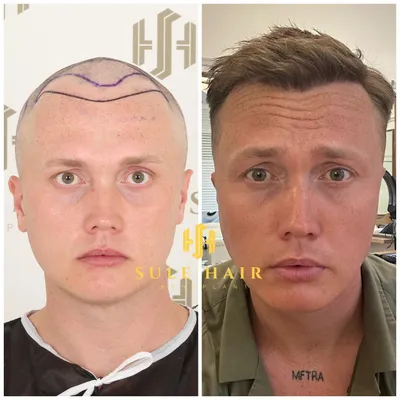 Sule Hair Clinic — Hair Transplant Istanbul