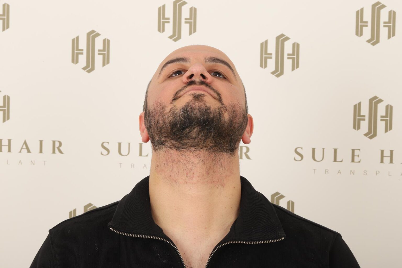Beard to Head Hair Transplant - SULE HAIR TRANSPLANT