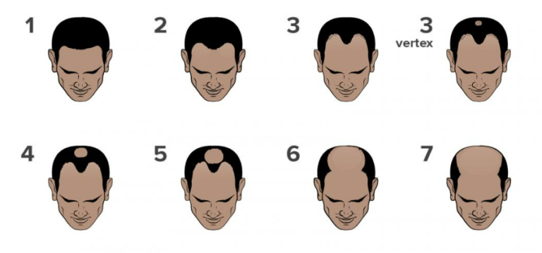 Understanding Hair Loss with Norwood Scale