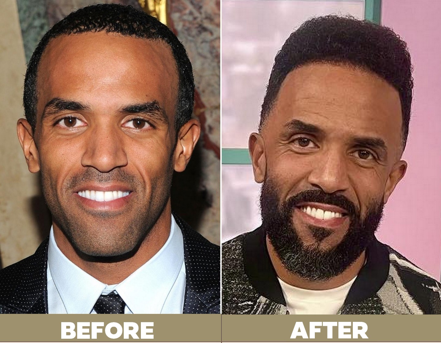 Craig David Hair Transplant - SULE HAIR TRANSPLANT