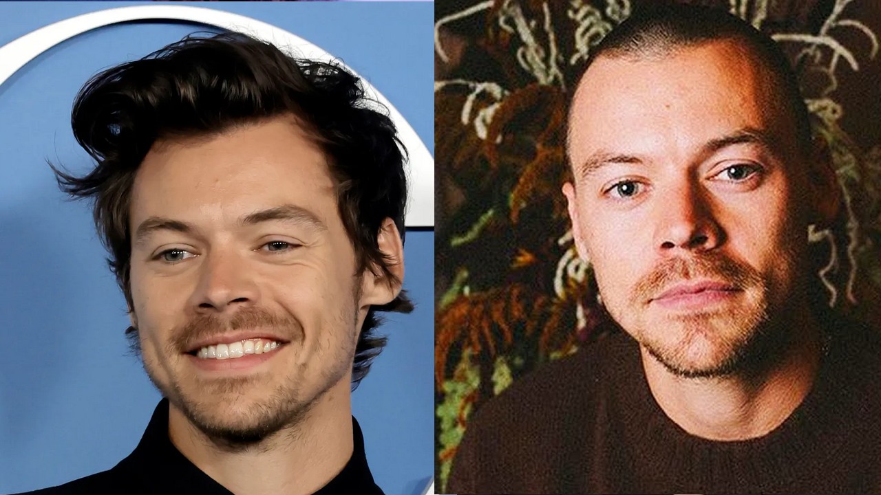 Harry Styles Hair Transplant: We Analyzed His Hair - SULE HAIR TRANSPLANT