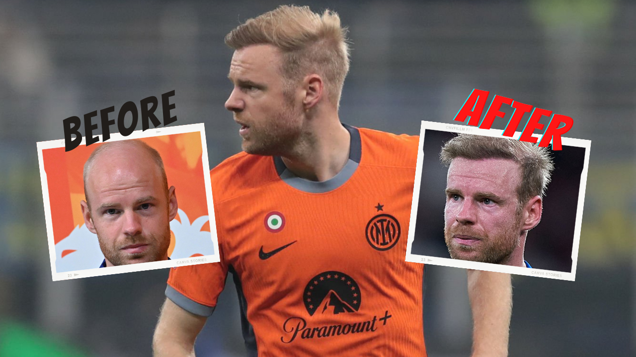 The Remarkable Transformation: Davy Klaassen's Hair Transplant Journey ...