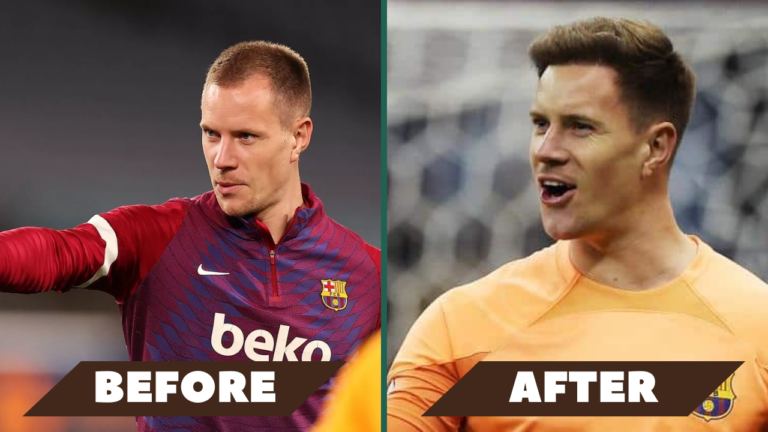 Ter Stegen's Inspiring Hair Transplant Story - SULE HAIR TRANSPLANT