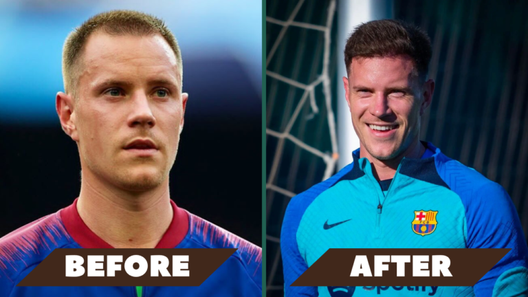 Ter Stegen's Inspiring Hair Transplant Story - SULE HAIR TRANSPLANT