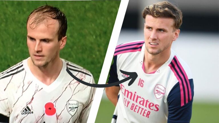 Rob Holding Hair Transplant - SULE HAIR TRANSPLANT