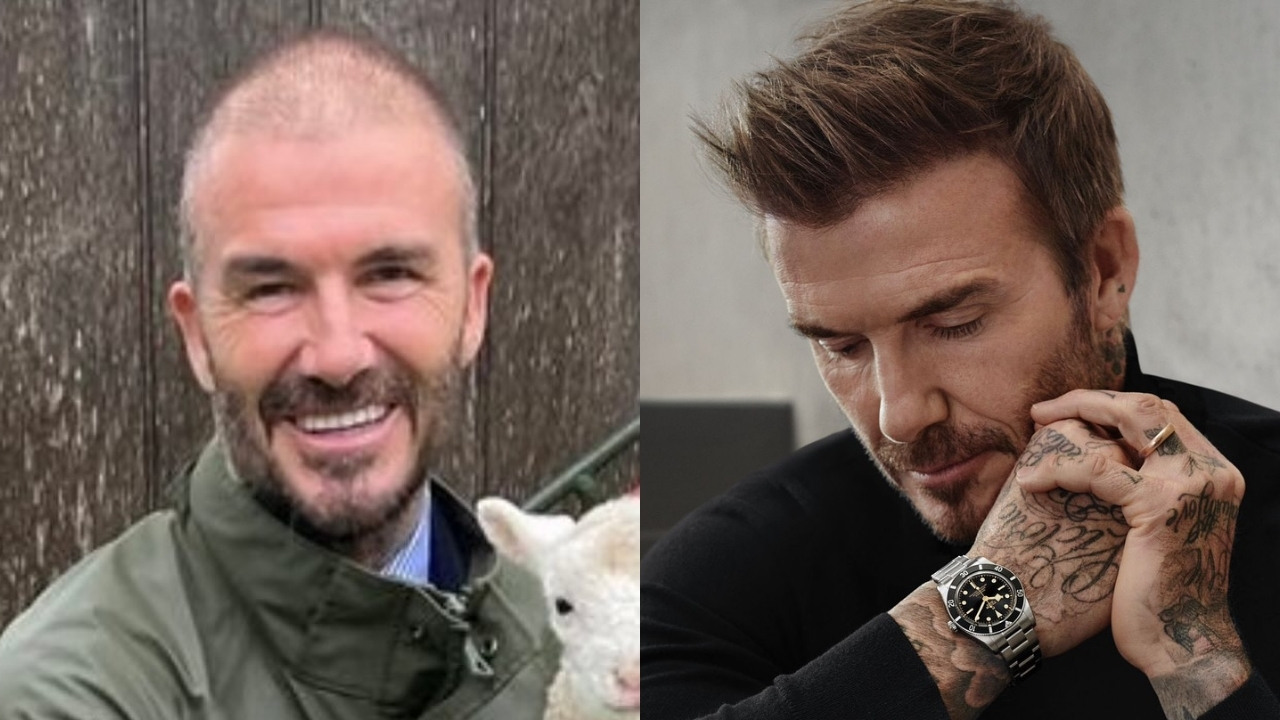 Beckham Hair Transplant - SULE HAIR TRANSPLANT