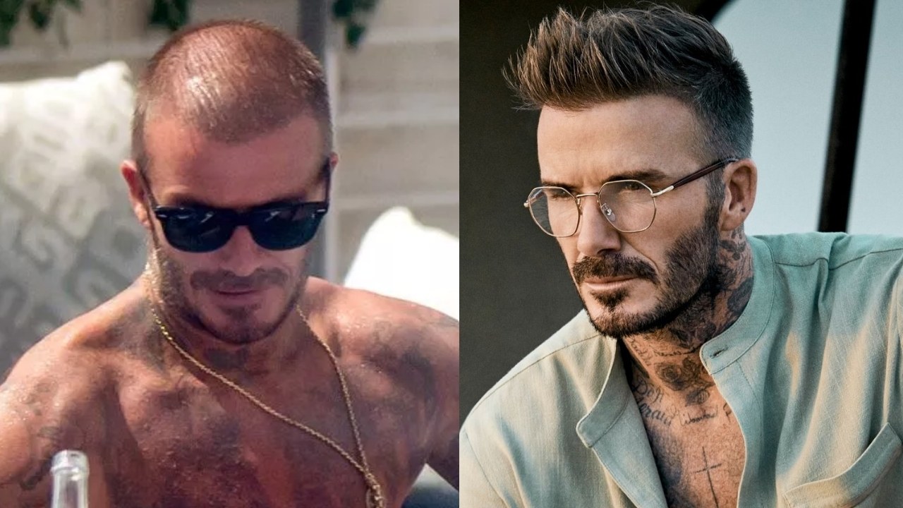 Beckham Hair Transplant - SULE HAIR TRANSPLANT