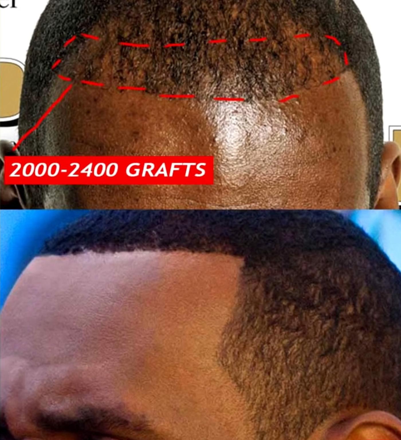 The LeBron James Hairline Chronicles - SULE HAIR TRANSPLANT