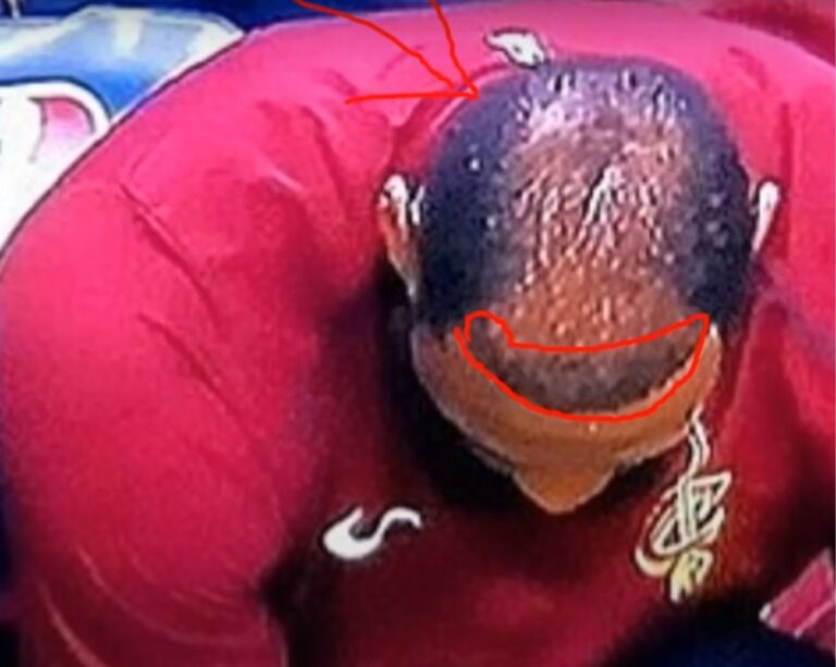 The LeBron James Hairline Chronicles - SULE HAIR TRANSPLANT