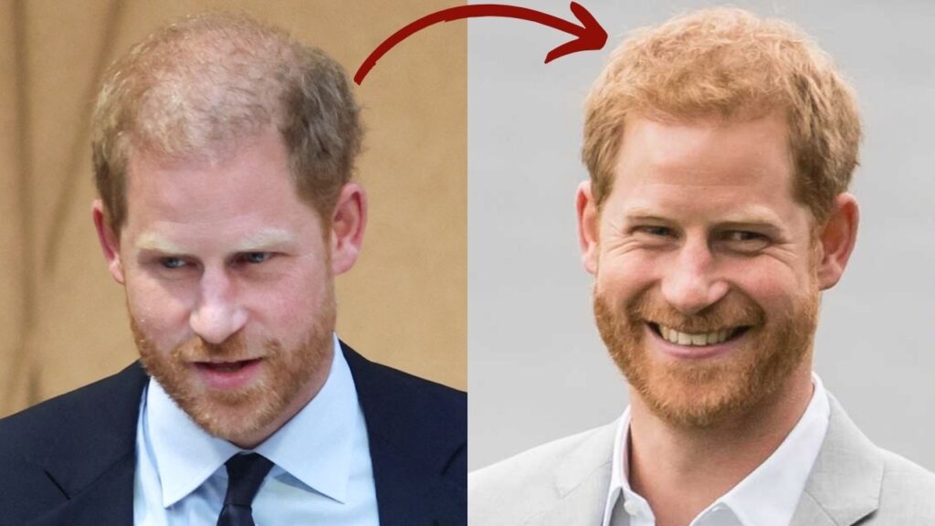 Prince Harry Hair Transplant: An Overview of Prince’s Hairline - SULE ...
