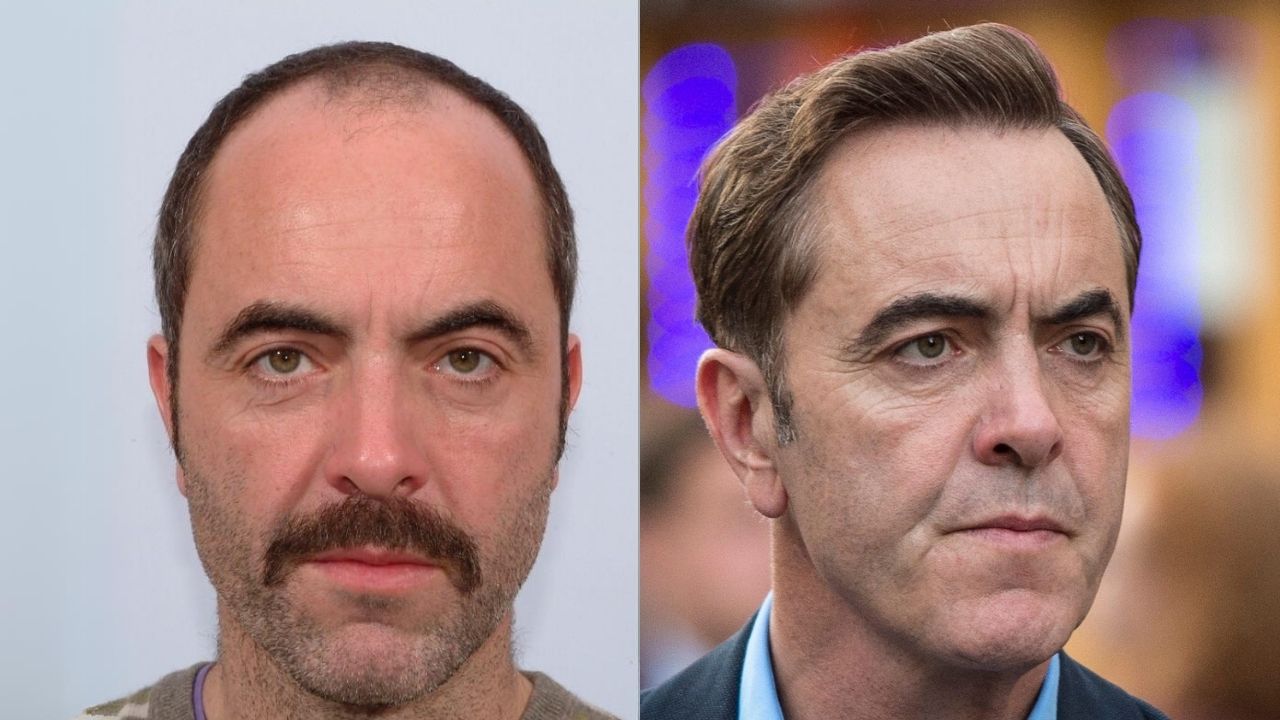British Celebrities Hair Transplants: Real Stories and Insights