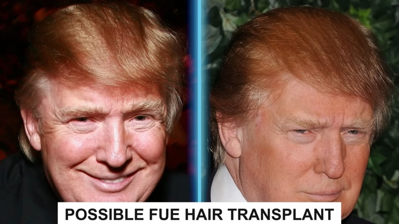 Trump vs. Biden: A Comparative Look at Their Hair Transplant Journeys ...