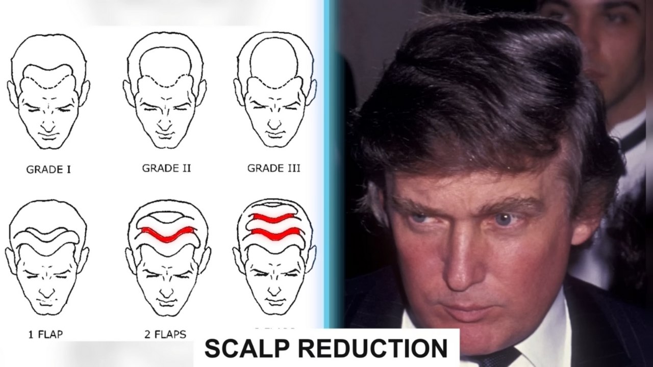 Trump vs. Biden: A Comparative Look at Their Hair Transplant Journeys ...