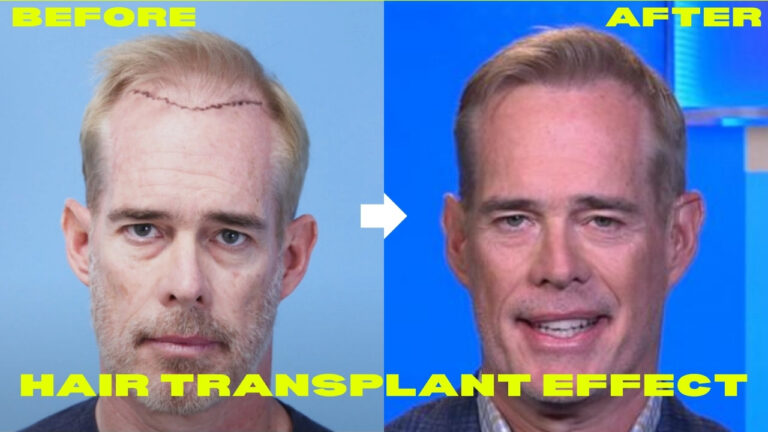 How Joe Buck's Hair Transplant Changed His Life and Career - SULE HAIR ...