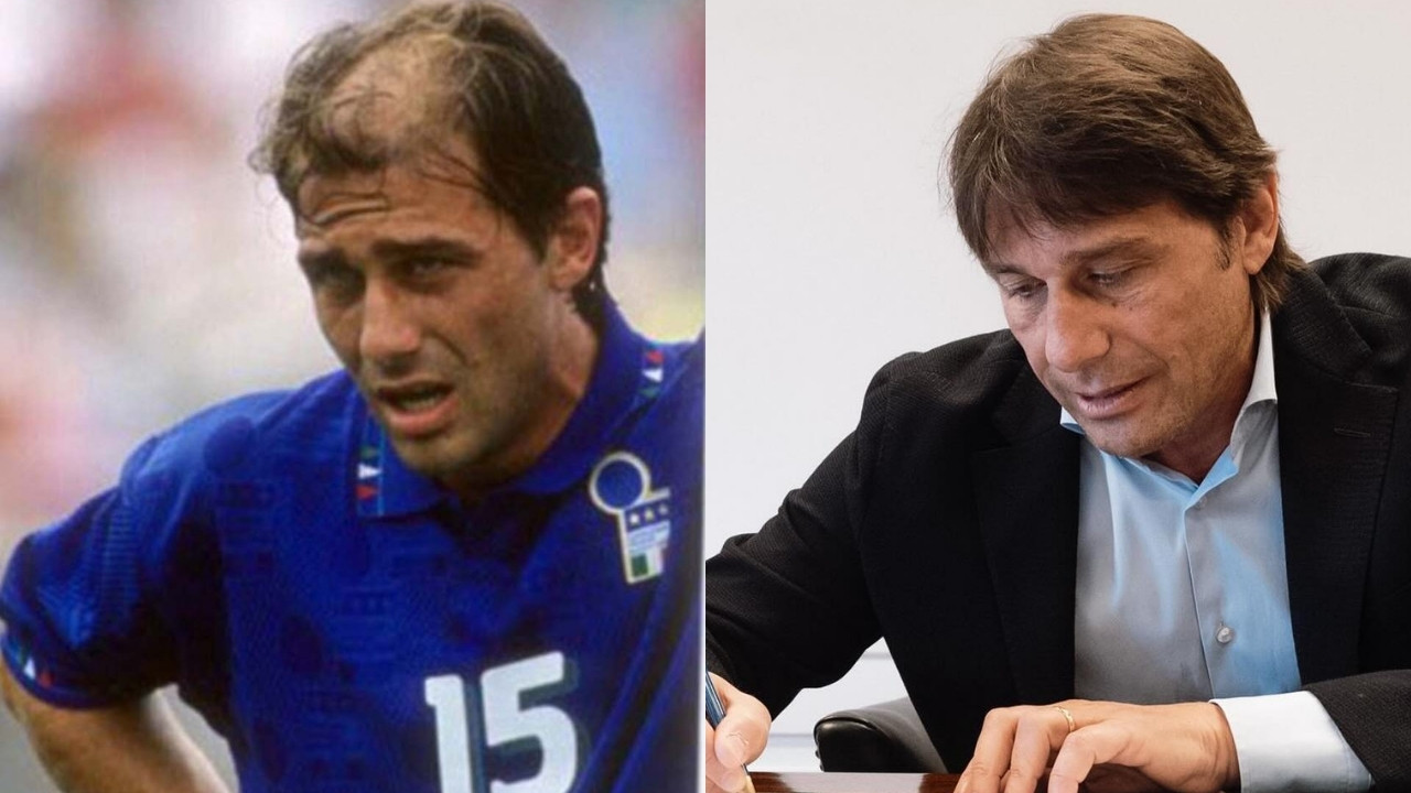 Antonio Conte's Hair Transplant: Expert Insights and Modern Techniques ...