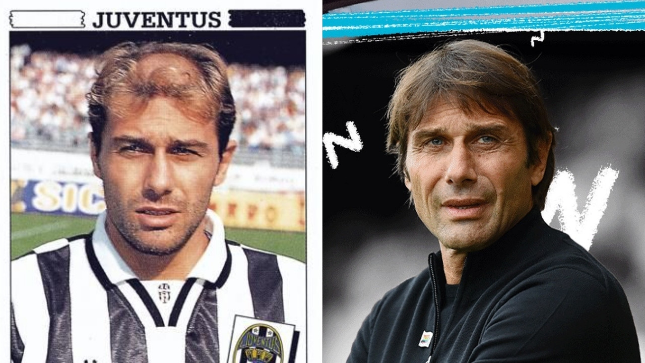 Antonio Conte's Hair Transplant: Expert Insights and Modern Techniques ...