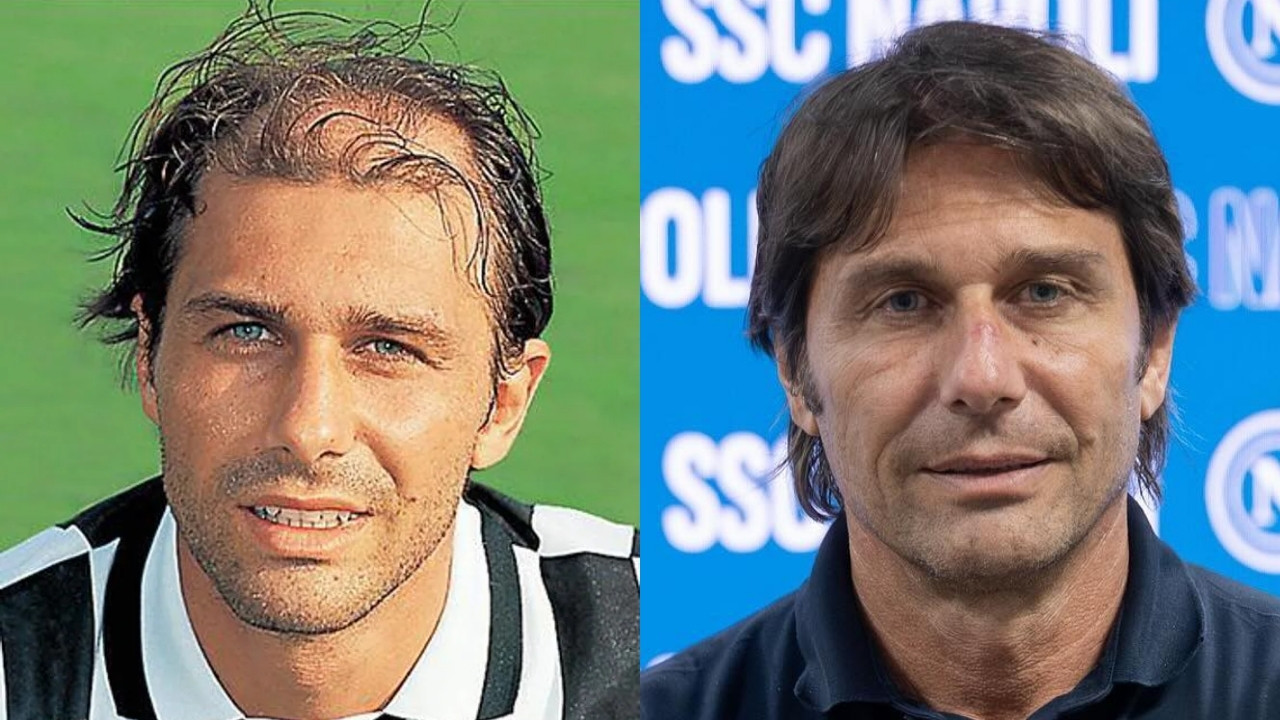 Antonio Conte's Hair Transplant: Expert Insights and Modern Techniques - SULE HAIR TRANSPLANT