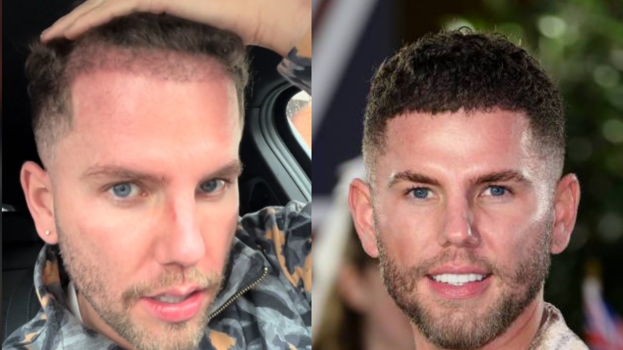 The Inside Scoop on Dean McCullough's Hair Transplant: Before and After ...